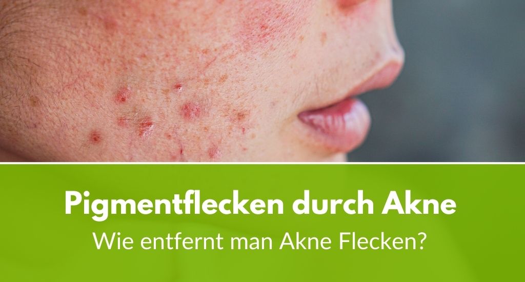 Pigmentflecken durch Akne: Wie entfernt man Akne Flecken?